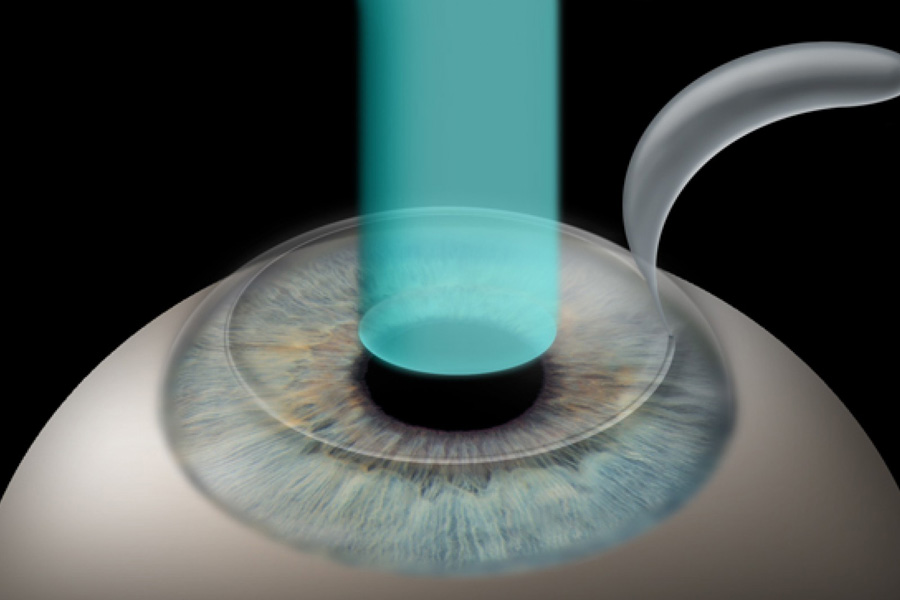 Tecnica PTK/PRTK - Chirurgia Refrattiva